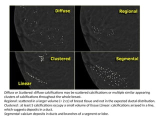 BREAST CALCIFICATIONS and related findigns.pptx
