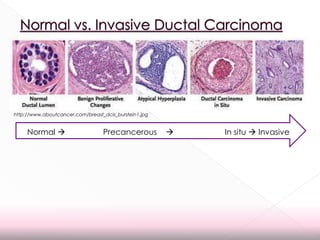 Breast Cancer - Molecular Basis of HER2+ Disease | PPTX