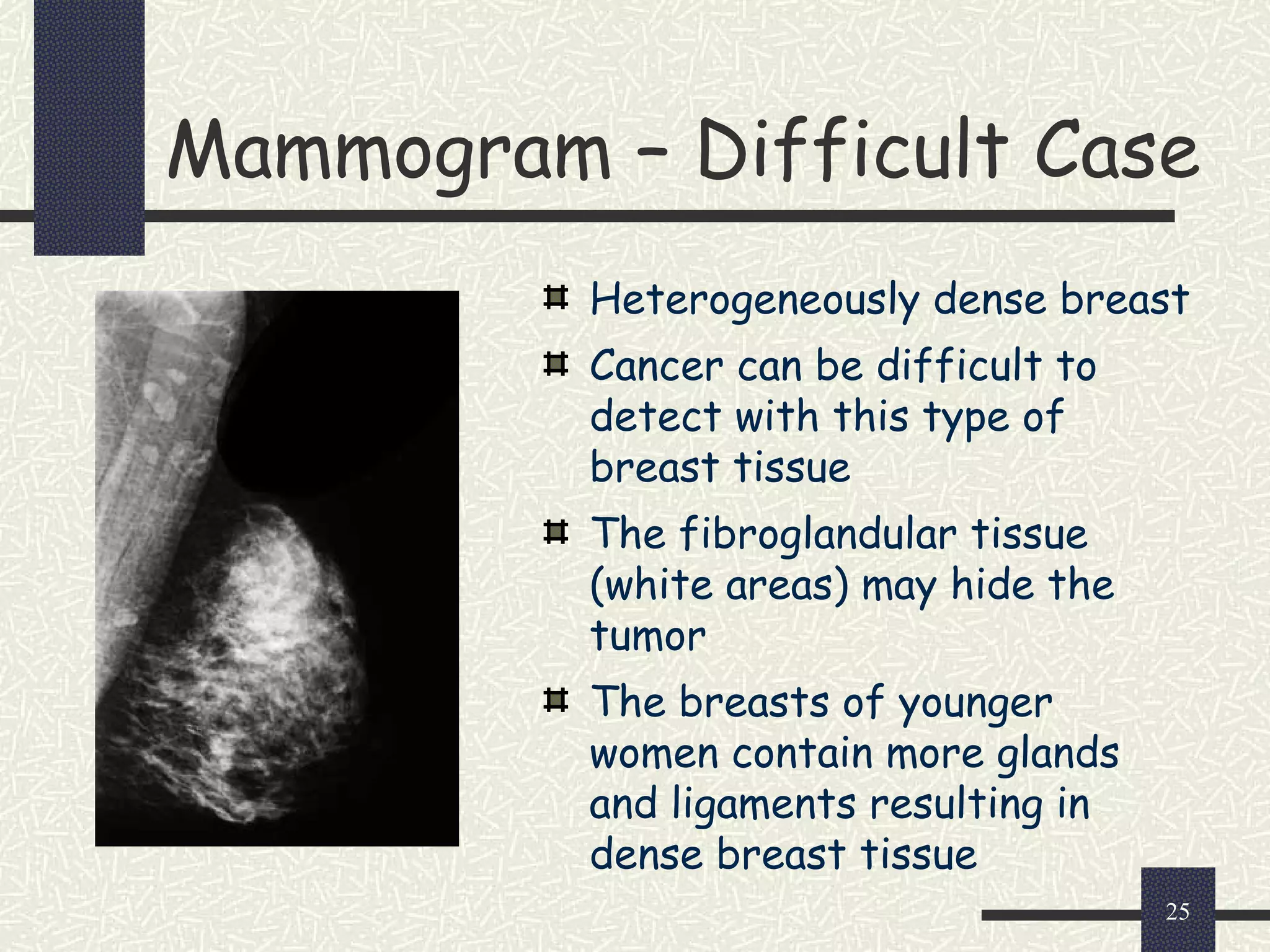 Breast cancer | PPT
