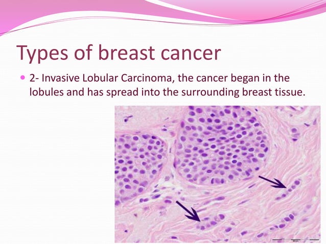 Breast cancer | PPTX | Cancer | Diseases and Conditions