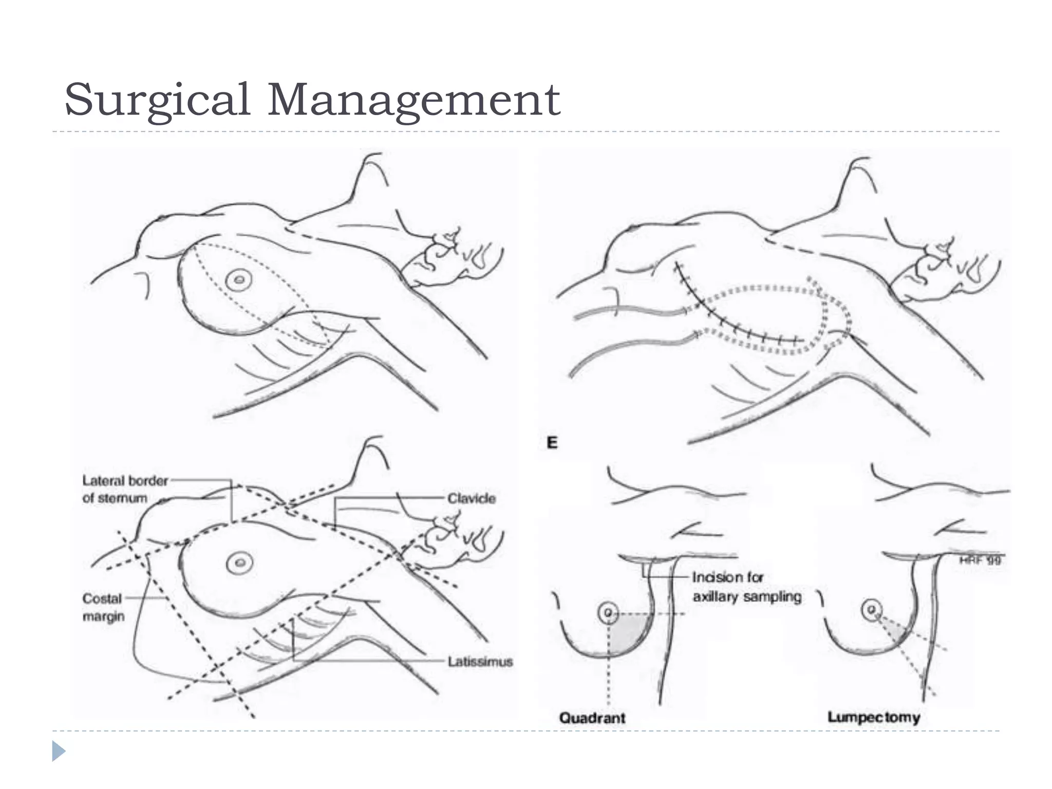 Breast Cancer Management & Surgical Considerations | PPTX