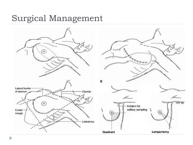 Breast Cancer Management & Surgical Considerations | PPTX