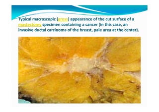 Breast Cancer Treatment in Kuching, Sarawak, Malaysia | PDF