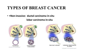 Breast cancer | PPTX