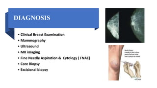 Breast cancer | PPTX