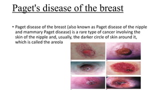 Breast cancer for nurses | PPTX