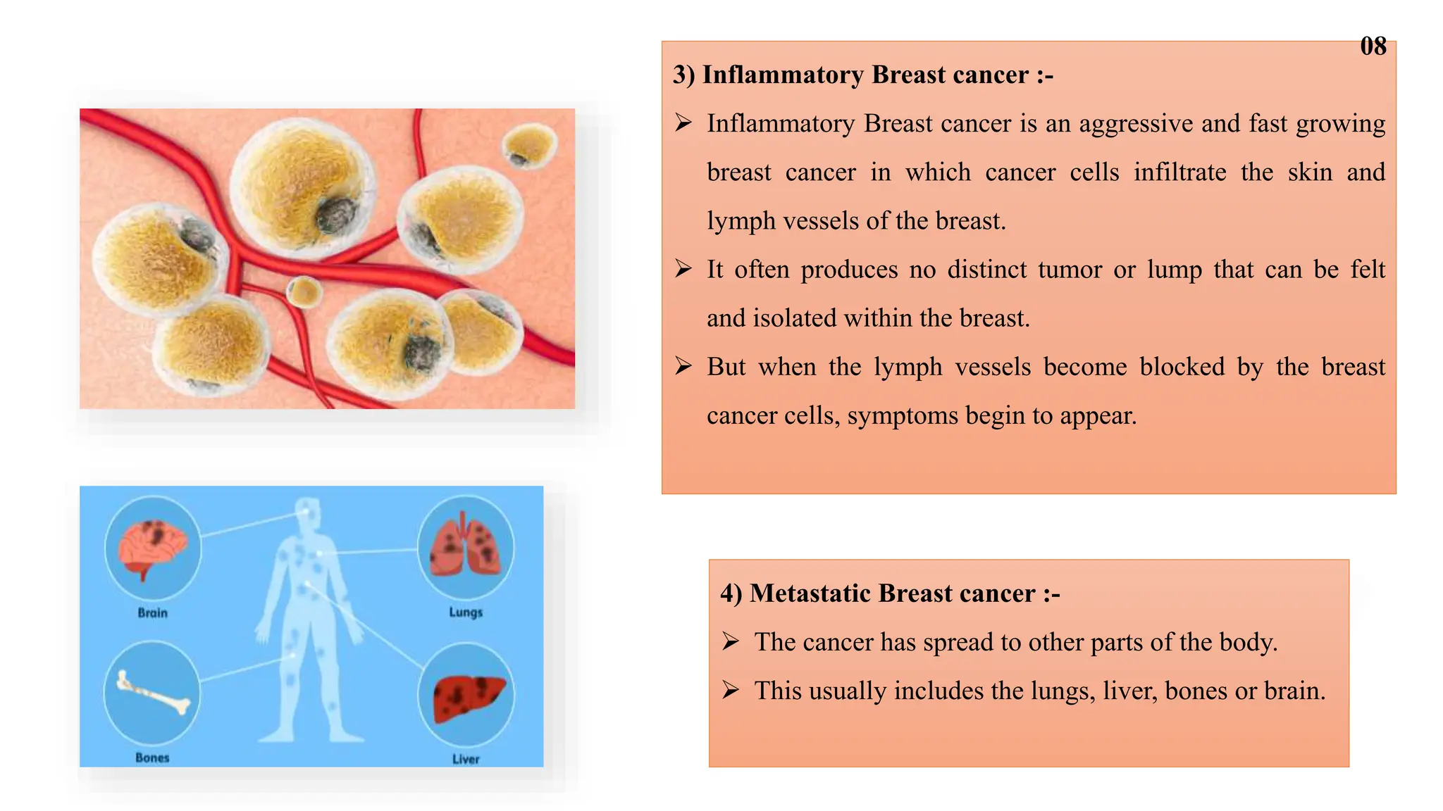 Breast Cancer and its types, signs and symptoms | PPTX