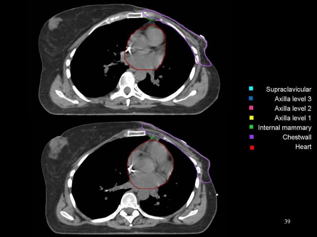 Atlas de contorneo RTGO breastcanceratlas.pptx