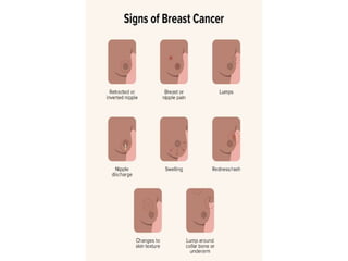 Breast Cancer by D. Isaac | PPT