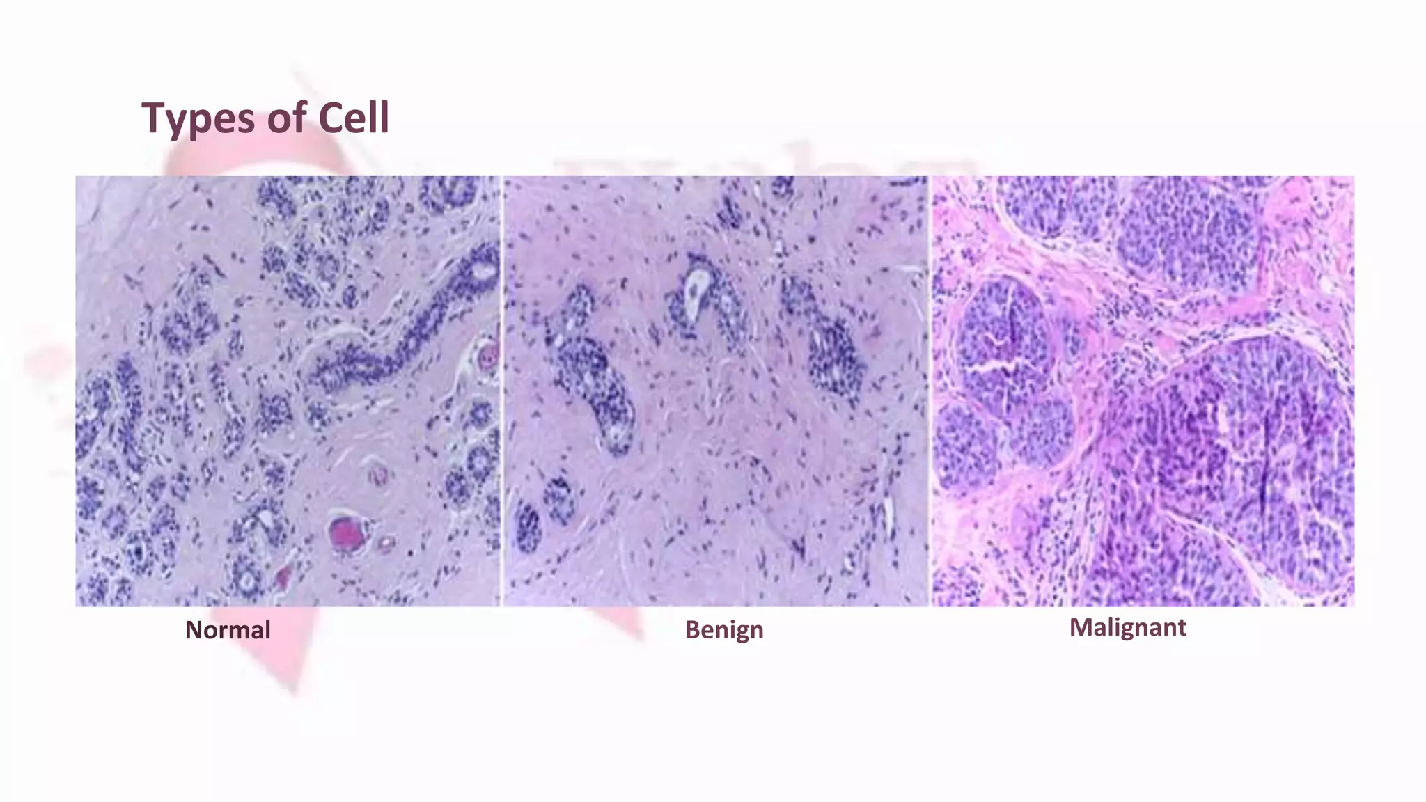 Breast cancer classification | PPTX