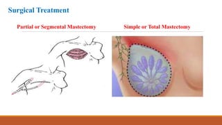Breast cancer for nursing | PDF