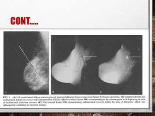 Breast cancer mri | PPT