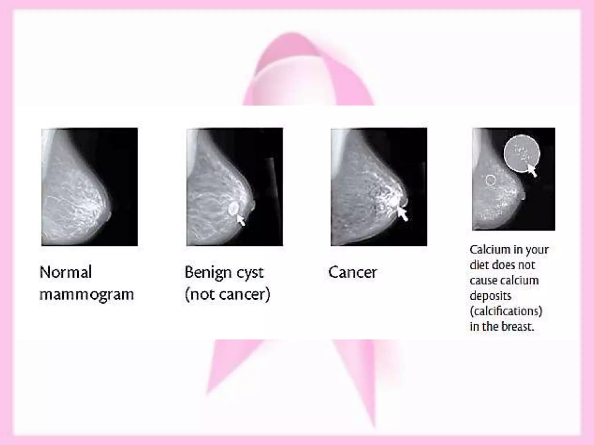 Breast cancer screening | PPTX