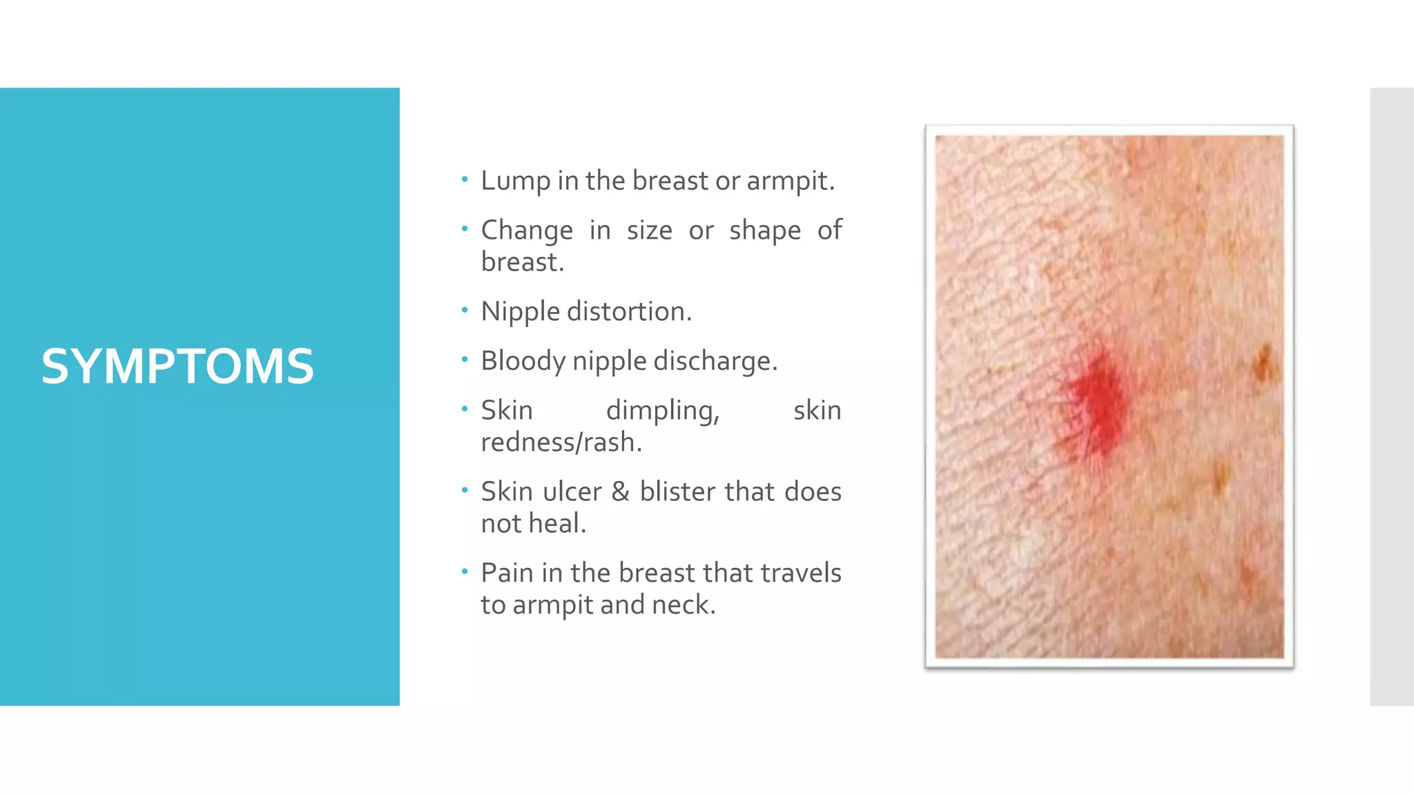 Breast cancer screening | PPTX