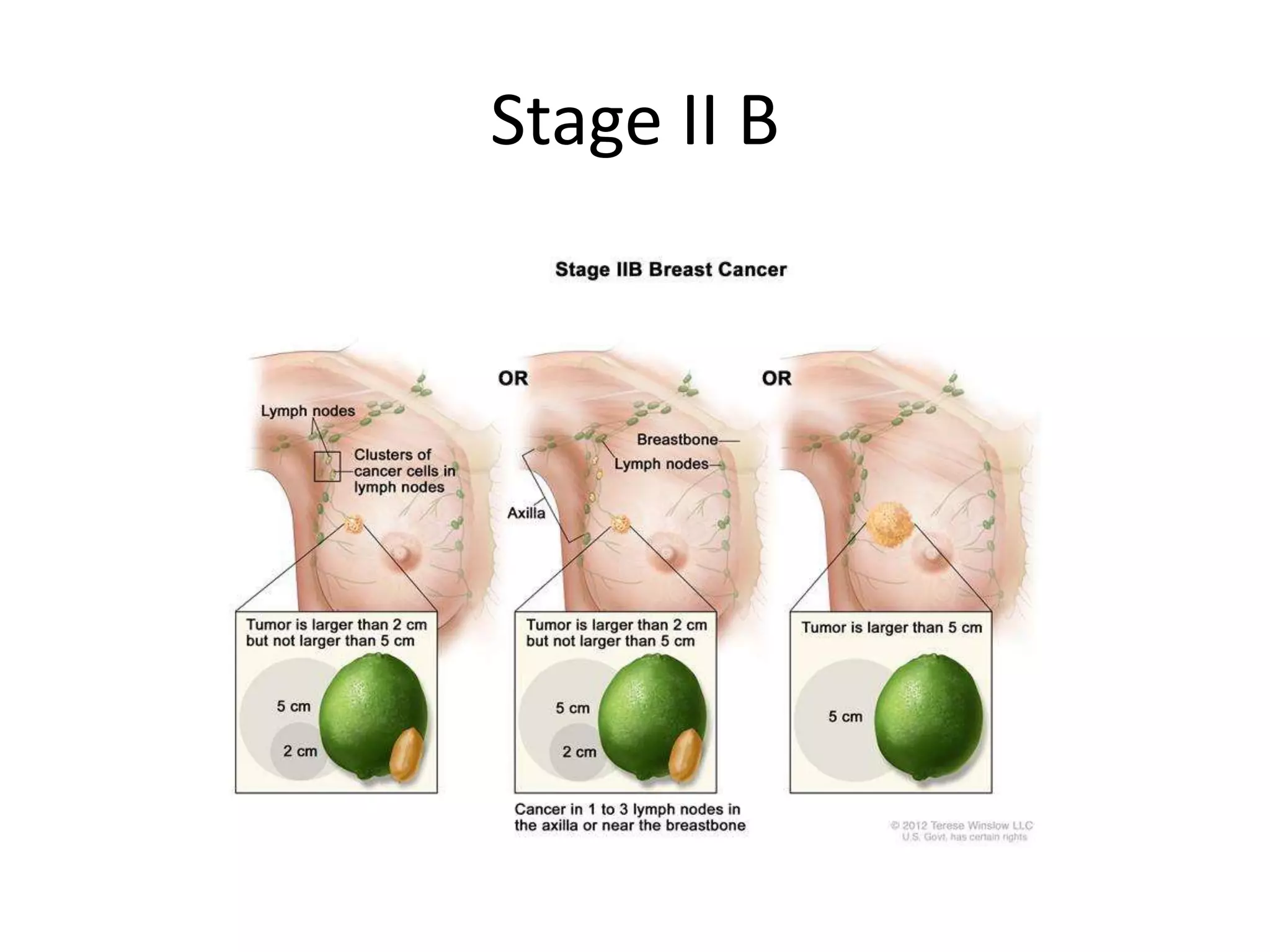 Breast cancer staging | PPTX