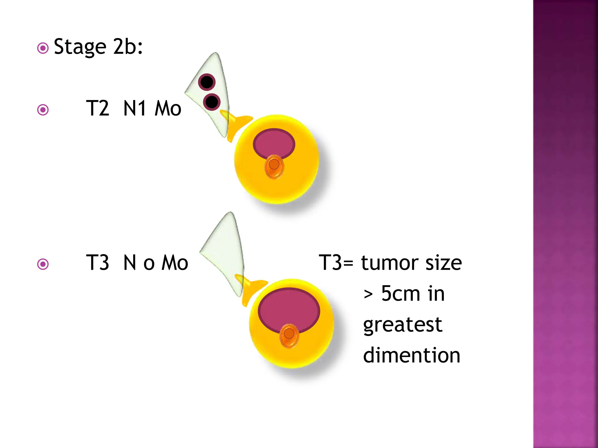 BREAST CANCER STAGING.ppt