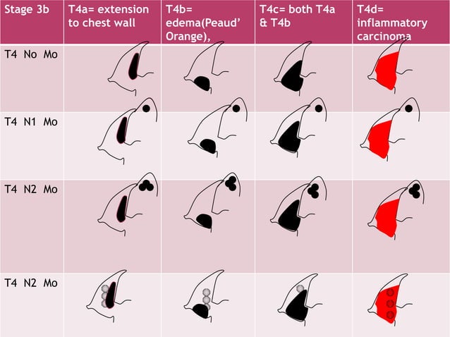 BREAST CANCER STAGING.ppt