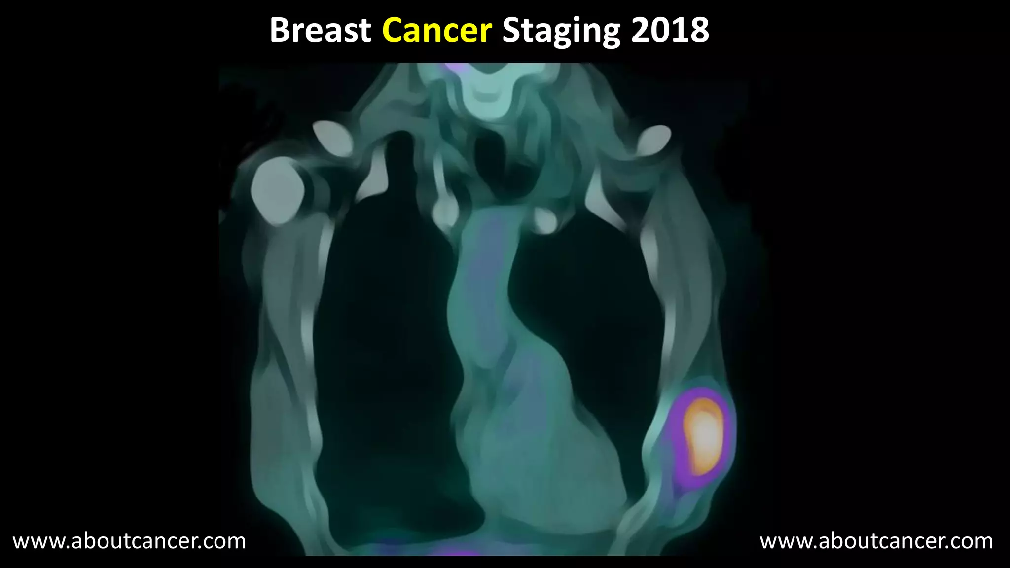 Breast cancer staging 2018 video power points | PPT