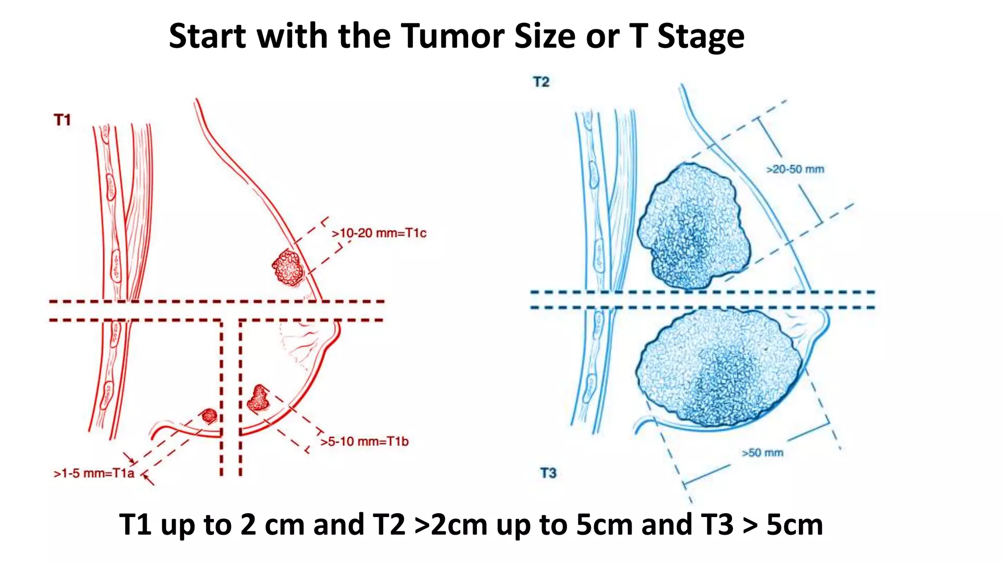 Breast cancer staging 2018 video power points | PPT