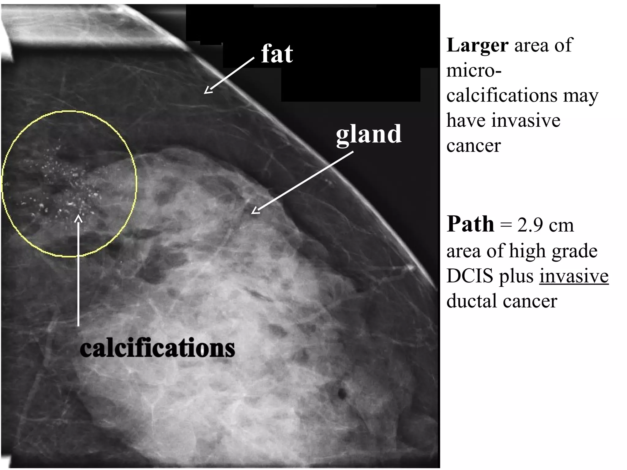 Breast cancer video 1 | PPT