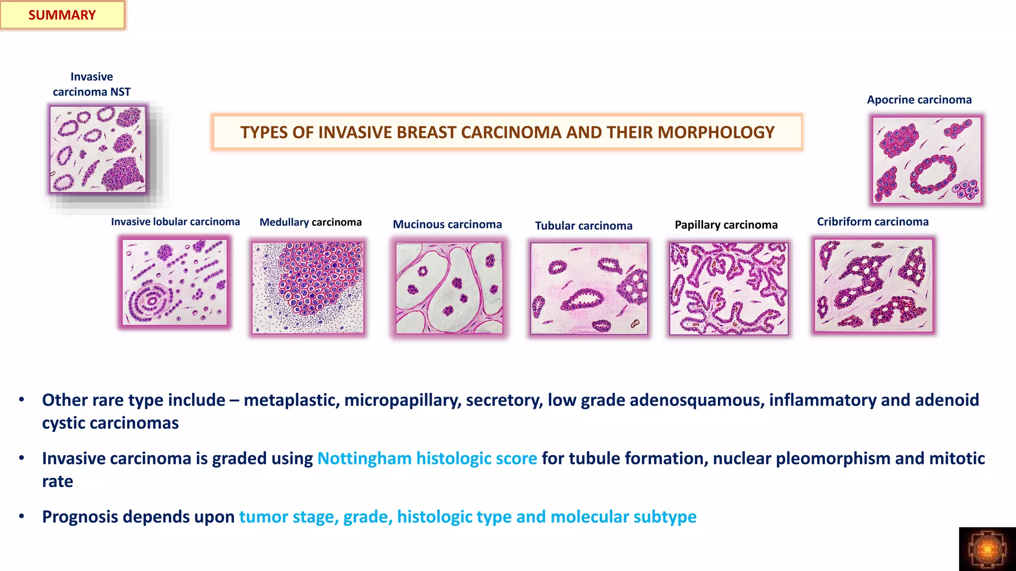 Morphology and prognosis of breast carcinoma - Dr.V.Shanthi | PPTX