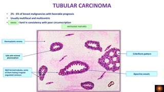 Morphology and prognosis of breast carcinoma - Dr.V.Shanthi | PPTX
