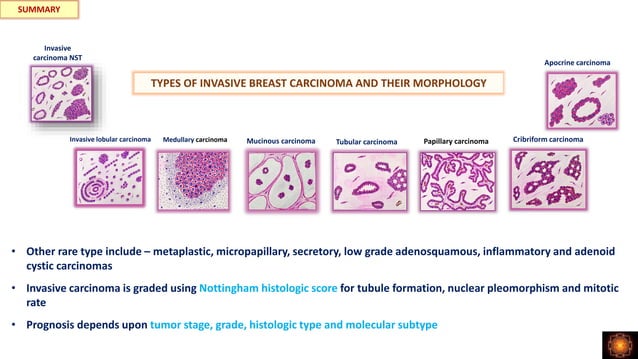 Morphology and prognosis of breast carcinoma - Dr.V.Shanthi | PPTX