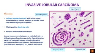 Morphology and prognosis of breast carcinoma - Dr.V.Shanthi | PPTX