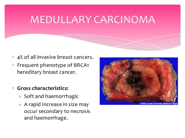 Breast Carcinoma