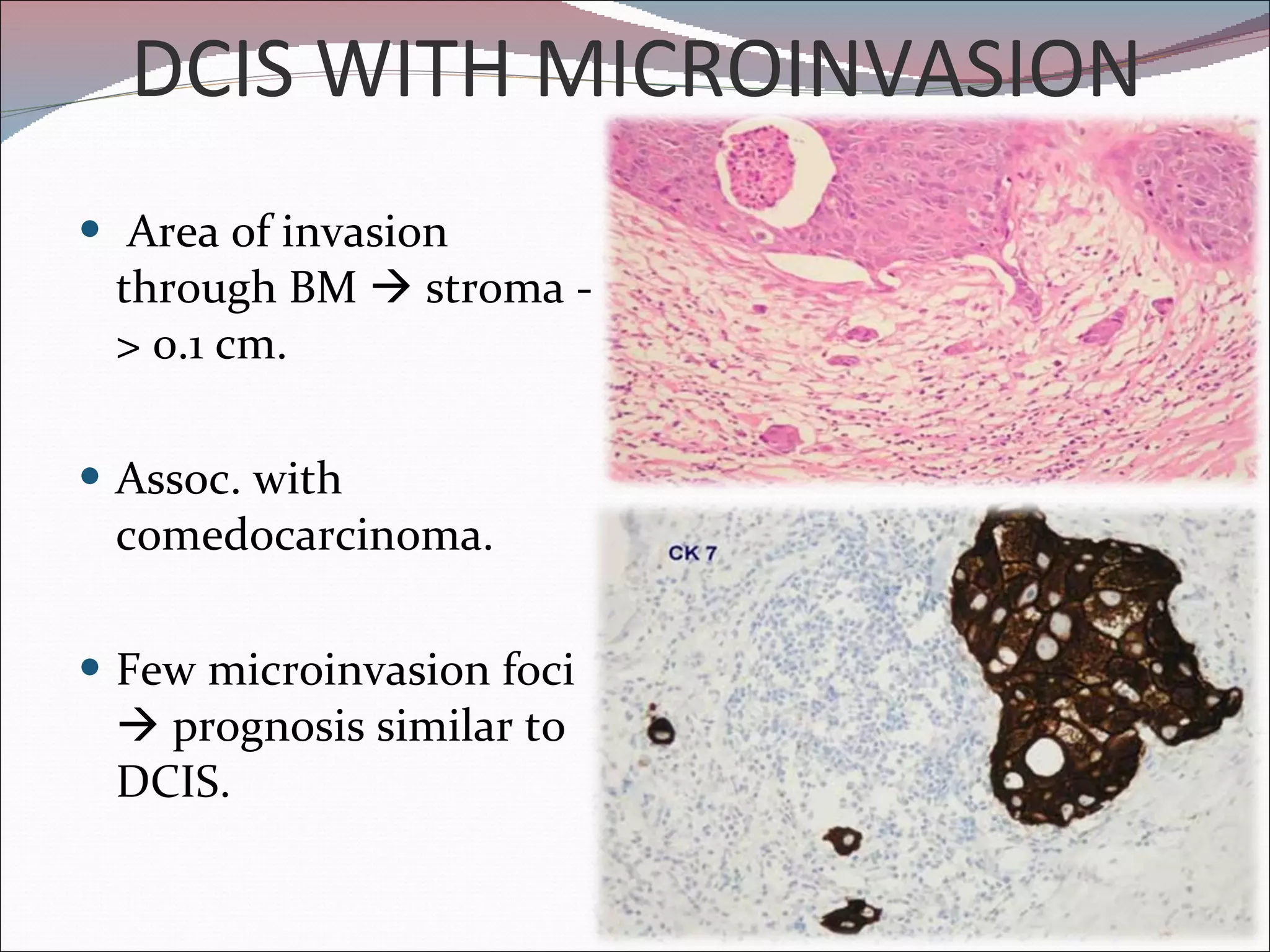 Breast carcinoma pathology | PPT