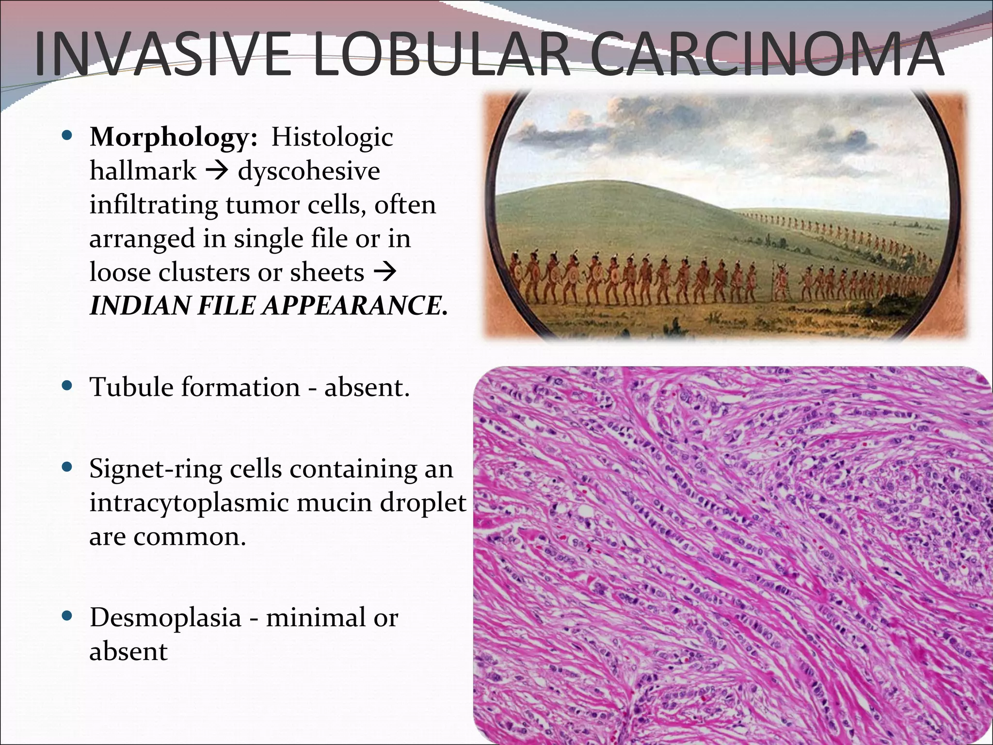 Breast carcinoma pathology | PPT