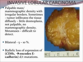 Invasive Ductal Carcinoma Gross