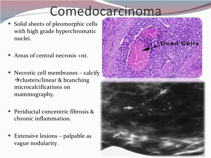Breast carcinoma pathology