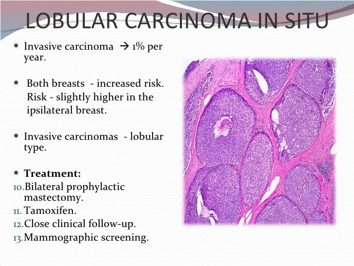 Breast carcinoma pathology
