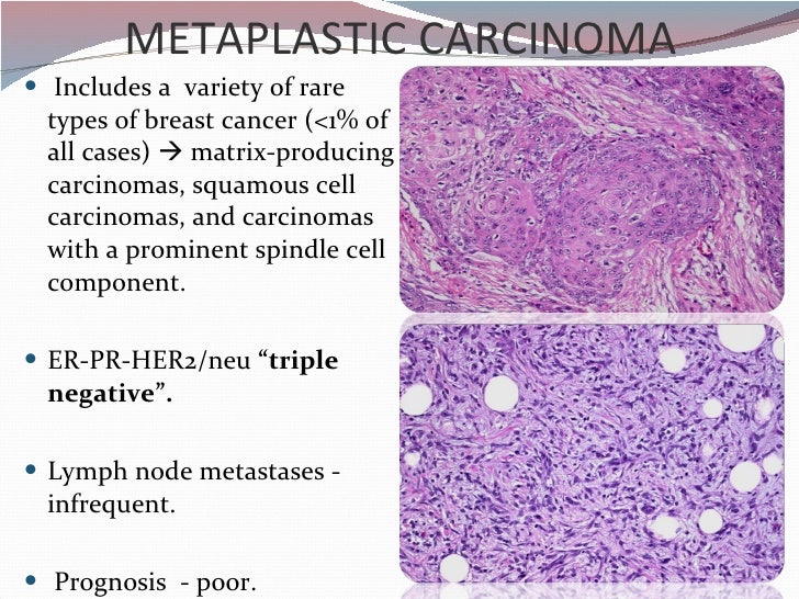 Breast carcinoma pathology