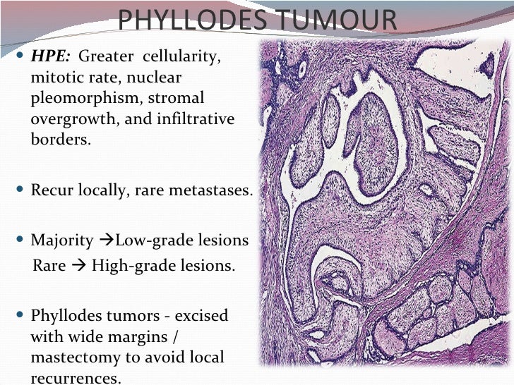 Breast carcinoma pathology