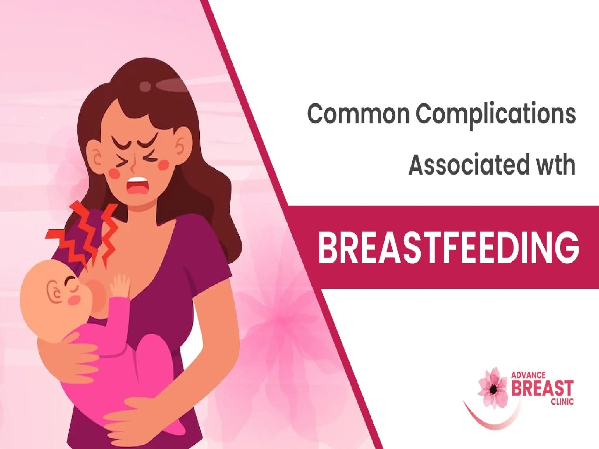 Breast Complications.pptx breast engorgement | PPTX