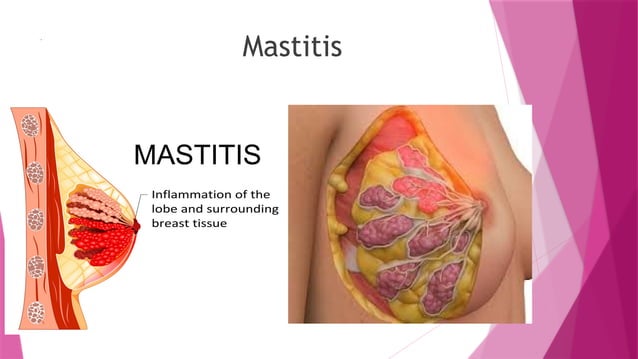 Complications of Breast During Puerperium.pptx
