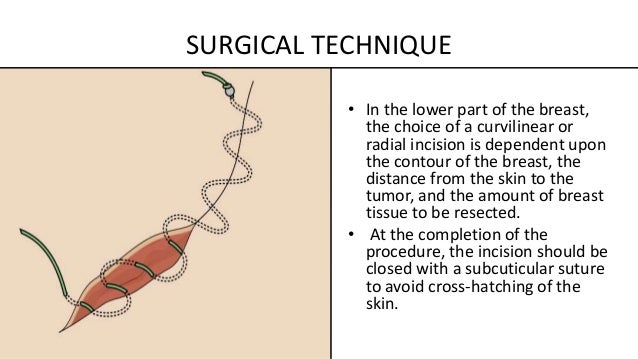 Breast conserving therapy/ Krūts saaudzējošā terapija