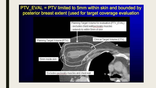 Breast contouring and planning techniques