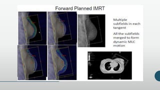 Breast contouring and planning techniques | PPT