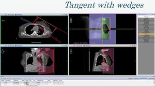 Breast contouring and planning techniques | PPT
