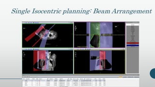 Breast contouring and planning techniques | PPT