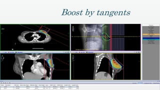 Breast contouring and planning techniques | PPT