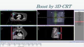 Breast contouring and planning techniques | PPT