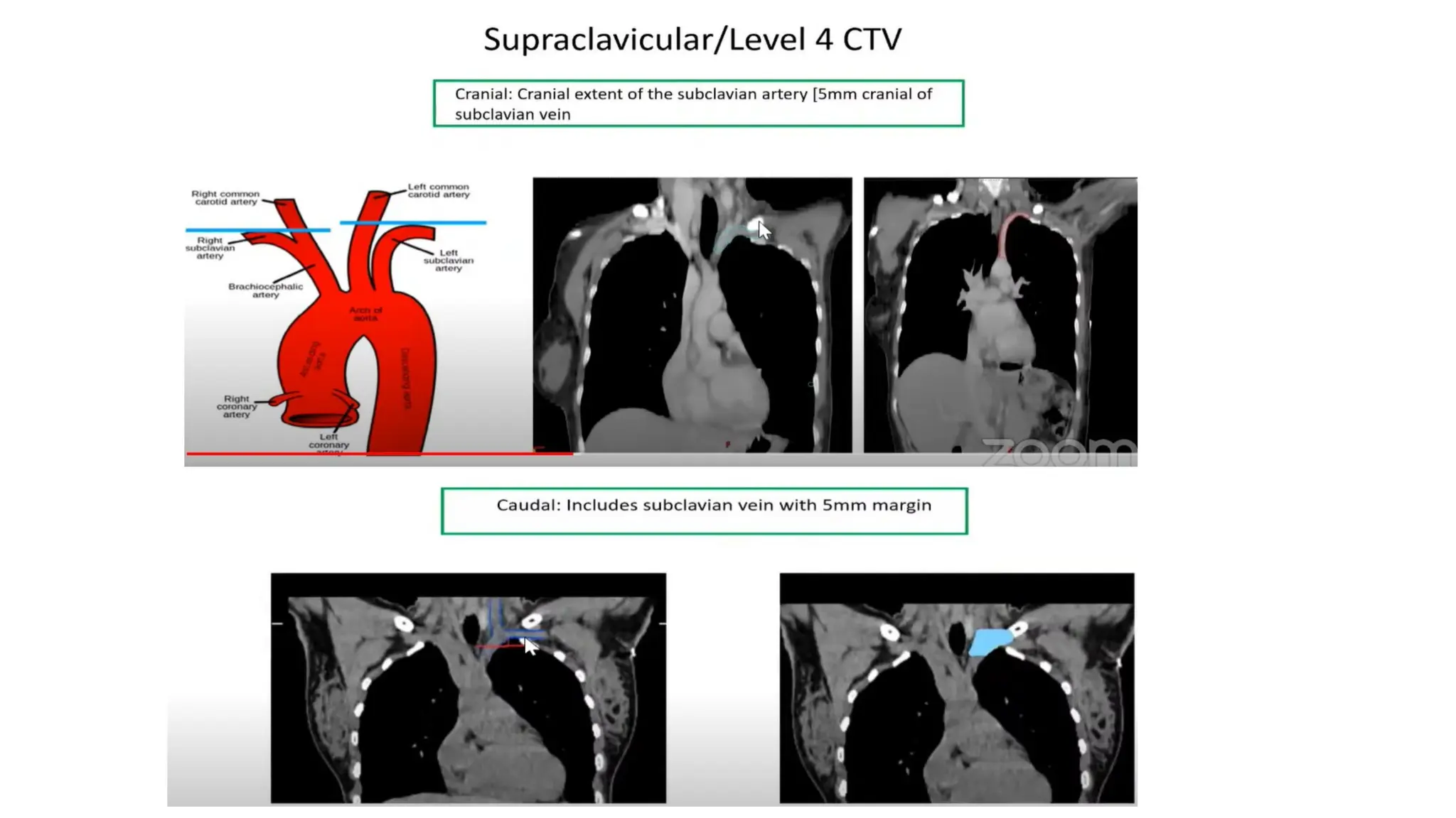 target delineation for breast and axillary nodes contouring.pptx