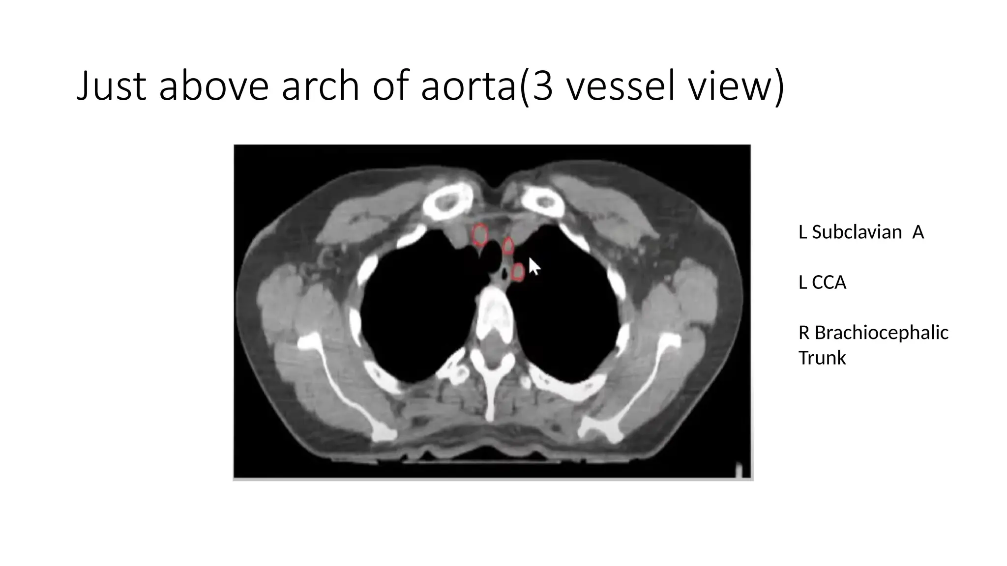 target delineation for breast and axillary nodes contouring.pptx
