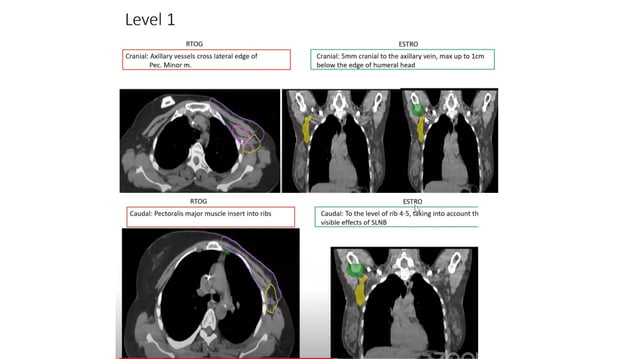 target delineation for breast and axillary nodes contouring.pptx