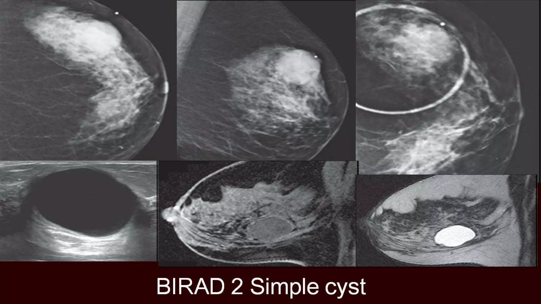 Breast cyst imaging | PPTX