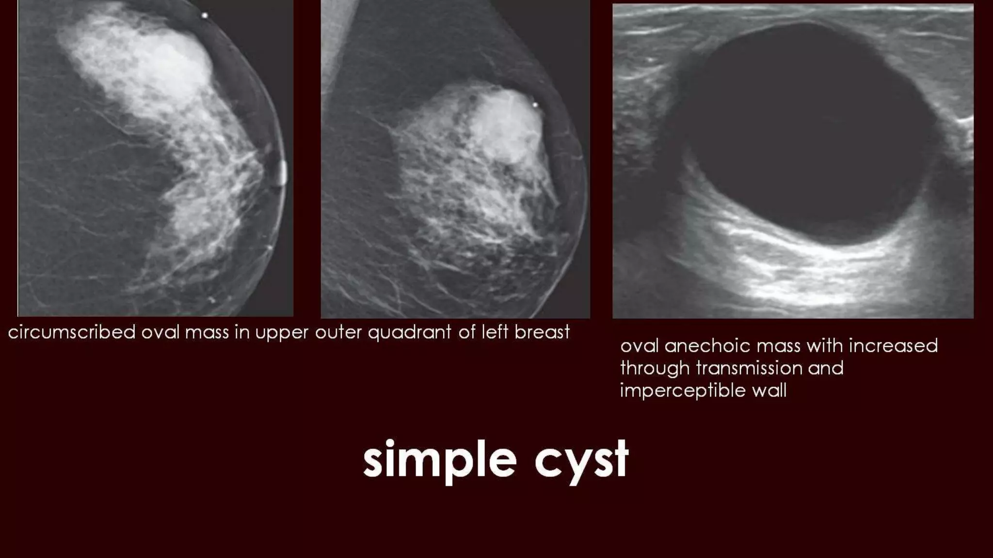 Breast cyst imaging | PPTX | Medical Health